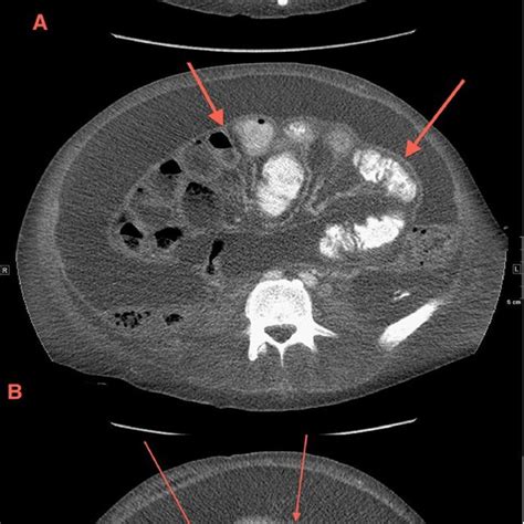 49 Year Old Male With Sclerosing Encapsulating Peritonitis Coronal