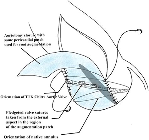 Aortotomy Closure Using The Augmentation Patch Valve Prosthesis