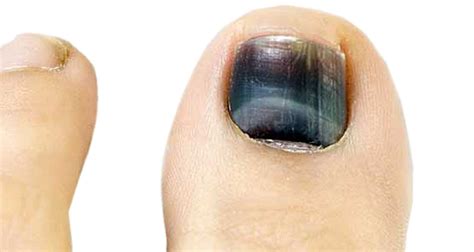 Hallux Rigidus Stiff Big Toe Symptoms Causes And Treatment