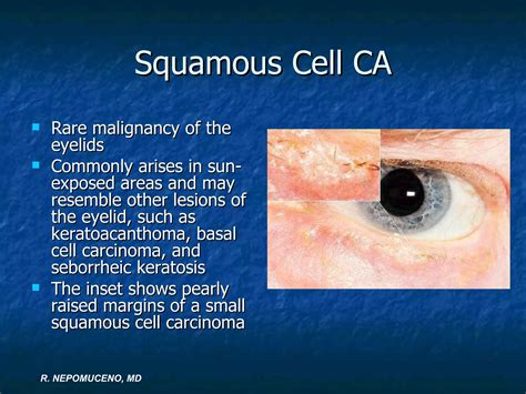 Edandcornea Lecture Fatima Ppt