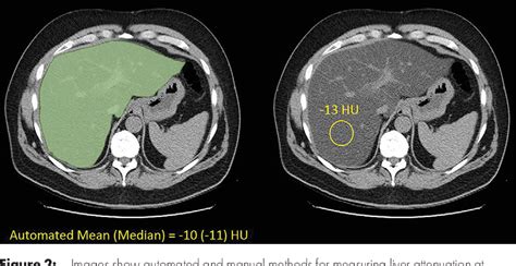 Figure 2 From Automated Liver Fat Quantification At Nonenhanced