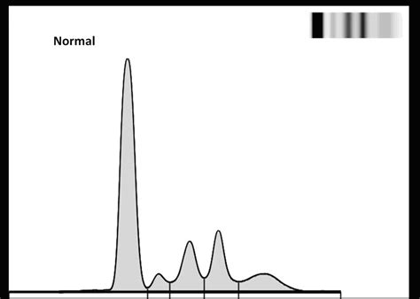 Electrophoresis Multiple Myeloma