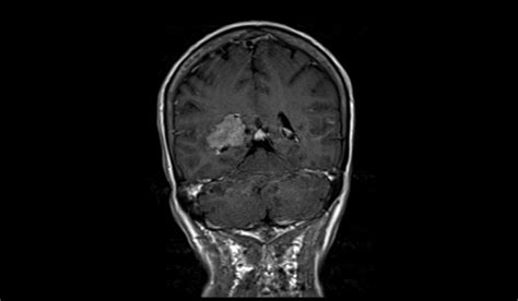 Choroid Plexus Papilloma Cpp Mri Radiology Article On Choroid