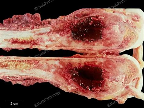Osteosarcoma Macroscopic Features