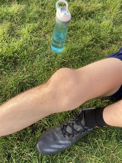 Dislocated Kneecap Rinjuriesandwounds