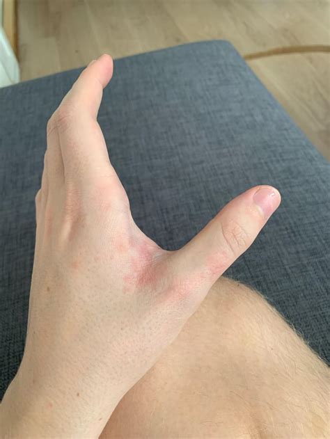 Is This Scabies Rscabies