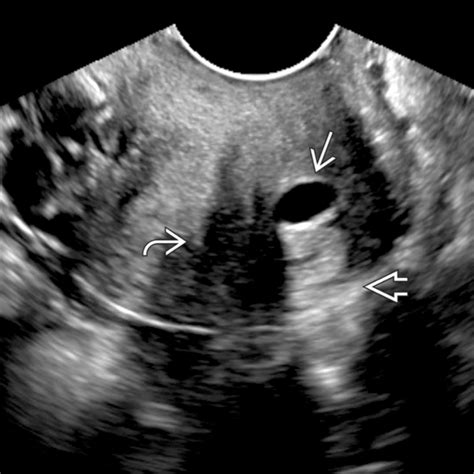Nabothian Cysts And Cervical Cancer Nabothian Cyst Radiology Key