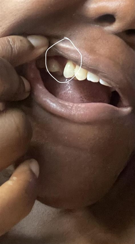 Replace Missing Tooth Rteeth