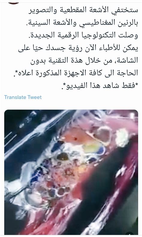 أنبه عن اشاعة تدور في عدة دول ووصلتنا هالايام حول اختفاء الأشعة المقطعية والتصوير بالرنين