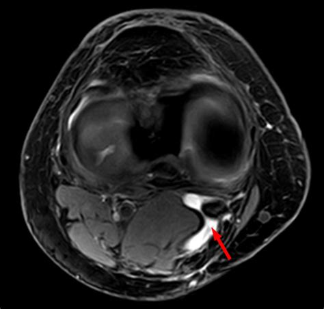 Bakers Cyst Foot At Xavier Brill Blog