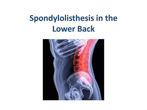 Spondylolisthesis In The Lower Back Pptx