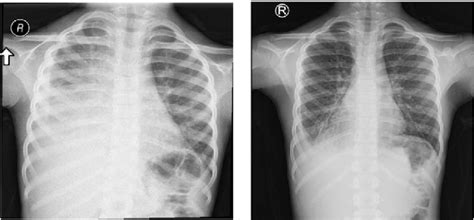 Figure 1 From Case Report Of Generalized Lymphatic Dysplasia With