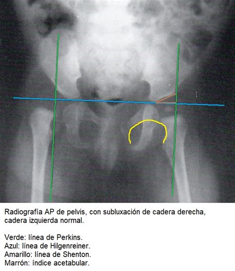 Displasia Del Desarrollo De La Cadera