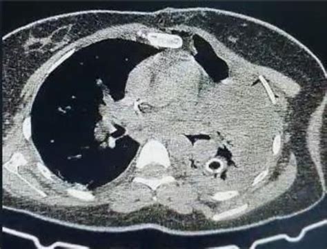 Tomografia Computadorizada De Tórax Com Coleção Em Hemitórax Esquerdo