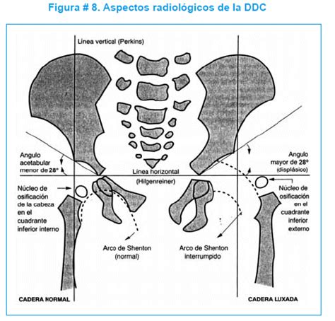 Displasia Congénita De Cadera