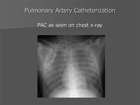 Ppt Pulmonary Artery Catheter Powerpoint Presentation Free Download