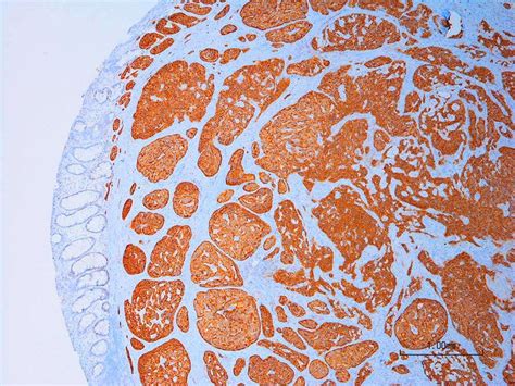 Disease State Biospecimens Buy Disease State Biospecimens