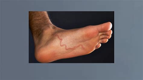 Most Effective Treatment For Hookworm Infections In Humans Genius Blogger