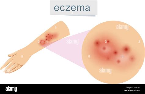 A Vector Of Eczema On Skin Illustration Stock Vector Image And Art Alamy