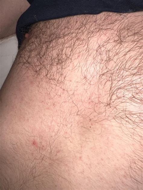 Does This Look Like Hiv Rash So Worried As Had Unprotected Sex 😢 Rhiv