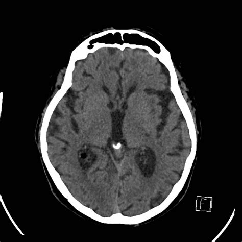 Plexus Choroideus Schafgehirn