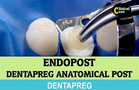 Endopost Dentapreg Anatomical Post