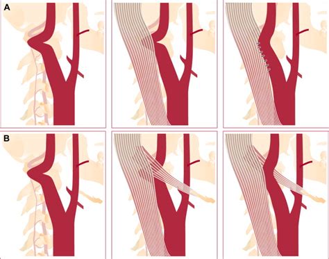 Posterior Transverse Plication Of The Internal Carotid Artery To