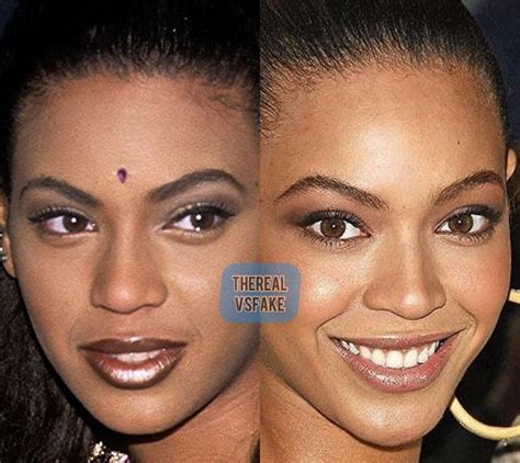 Beyonce Before After Nose Fillers Celebrity Surgery Nose Fillers Ethnic Rhinoplasty