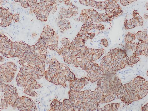 Breast Cancer Her2 Detection Under Fluorescence Microscopy Mshot