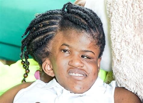 Conjoined Twins With A Life Expectancy Of 10 Years Thrives At 18