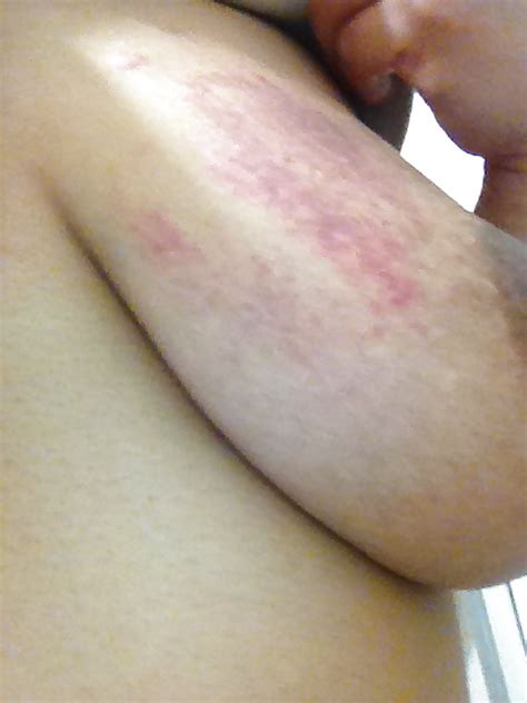 Bruised Tits Porn Pictures Xxx Photos Sex Images 1837062 Pictoa