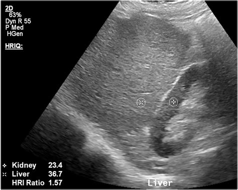 Multiparametric Ultrasound For Chronic Liver Disease Radiologic Clinics