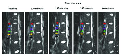 Example Of Diffusion Weighted Image DWI Showing How The Vertebra Of Download Scientific