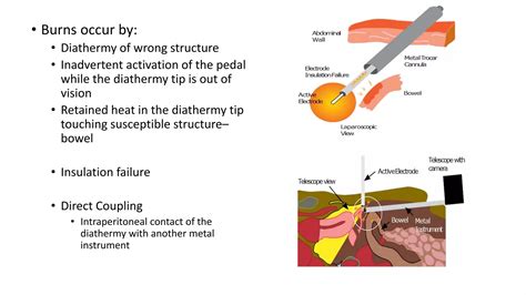 Diathermy Principles And Types Pptx