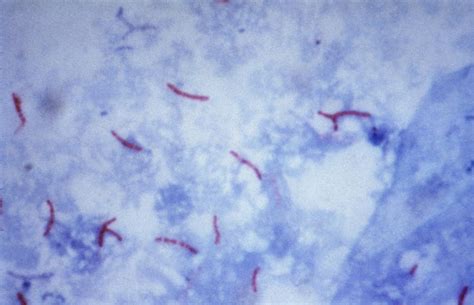 Tuberculosis Slide