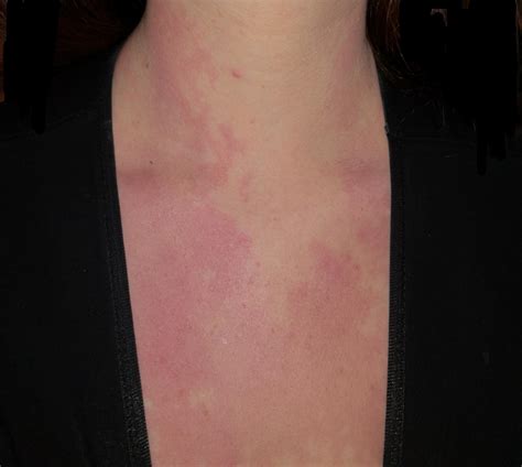 Rosacea Chest