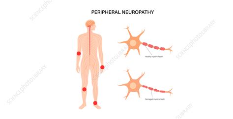 Peripheral Neuropathy Illustration Stock Image F0460754 Science