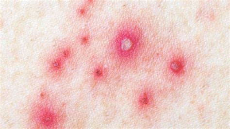 What Are The Stages Of Shingles Dermeleve Dermeleve®