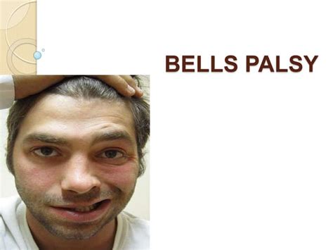 Bells Palsy Pptx