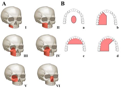 Browns Revised Classification Of Maxillary And Midfacial Defects [4] Download Scientific