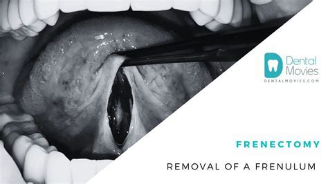 What Is The Difference Between Frenuloplasty And Frenectomy
