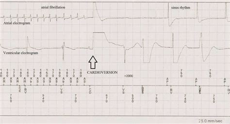 Evaluating The Efficacy And Safety Of Internal Cardioversion With