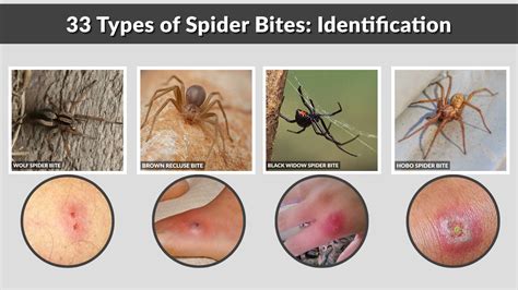 33 Types Of Spider Bites Identification Danger Levels And Pictures