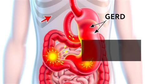 Endometriosis Link To Gerd Know The Facts