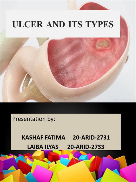 Ulcer Ppt 1 Pdf Medical Specialties Clinical Medicine