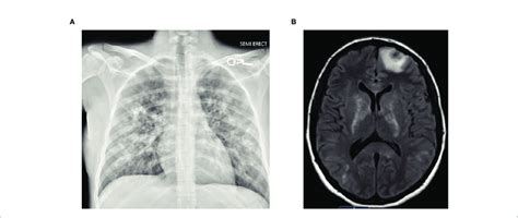 A Chest X Ray Revealing Diffuse Interstitial And Airspace