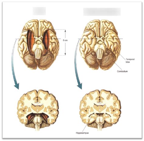 Lecture 23 Memory And Amnesia Ii Diagram Quizlet