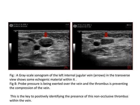 Venous Doppler Upper Limb Pptx