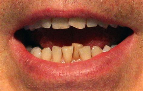 Dentists Claim Mask Mouth Is Deteriorating Peoples Teeth