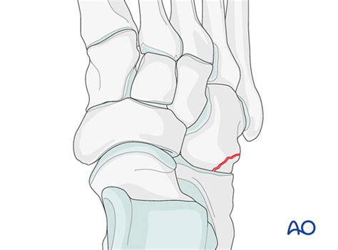 Cuboid Avulsion Fracture